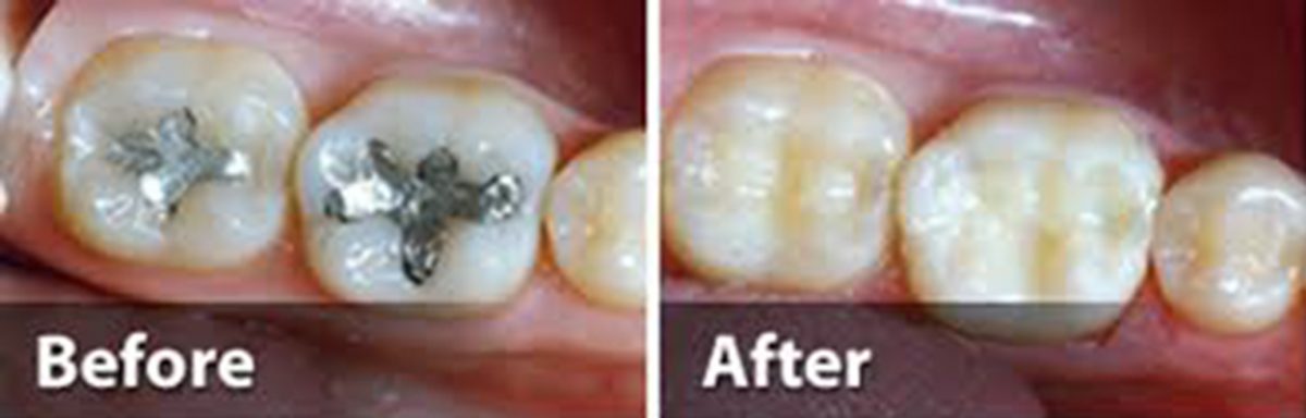 Tooth-Coloured Fillings | Queensgate Dental | Natural-Looking Solutions